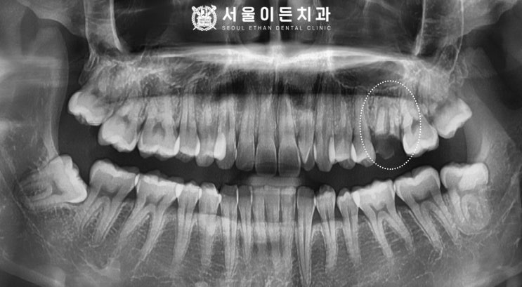 불광동 치과 잔존 치근치아 뿌리 발치 후 즉시 임플란트 식립 상악동 거상술 동반 사례 네이버 블로그