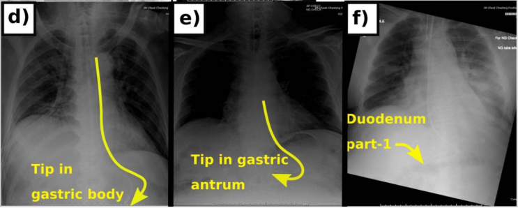 X-ray 상 NG tube(L-tube)의 위치 확인 : 네이버 블로그