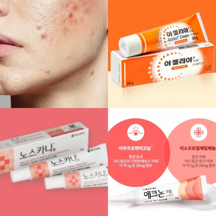 여드름 연고 종류 화농성 안짜지는 여드름 좁쌀여드름 없애기 네이버 블로그