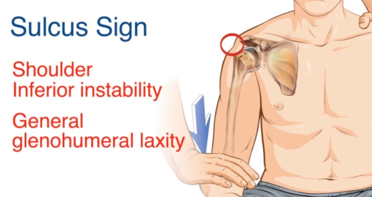 Sulcus Test 어깨에 고랑?! 무슨 문제인지 알아보자 : 네이버 블로그