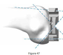 [Knee/TKRA] Femur AP cutting / Posterior release : 네이버 블로그