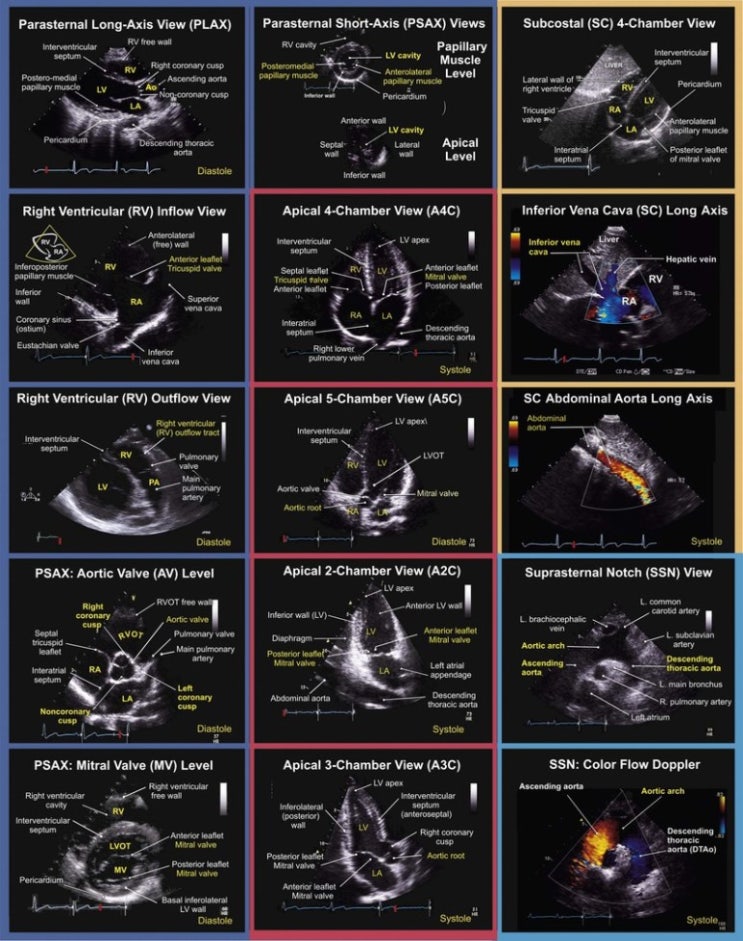 Echo PLAX(parasternal long axis view) 11개 view, LV dimension, M-mode 그 ...