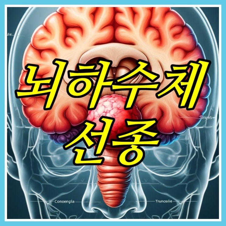 뇌하수체선종 원인은 호르몬 분비 이상 방사선 노출 두통 시력 장애 생리 불순 증상 수술로 치료하세요 네이버 블로그