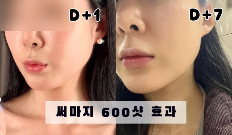 써마지 효과 시기, 가격, 주의사항 후기 (flx 600샷, 청담동 피부과) : 네이버 블로그