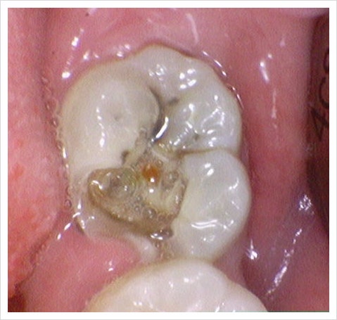 Lower Molar tooth Extraction, Implant and Bone Grafting : 네이버 블로그
