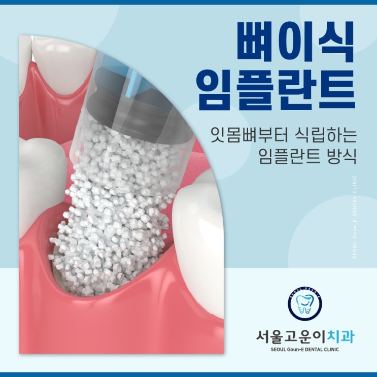 신풍역 치과 뼈이식임플란트 꼭 필요한 과정인가요 네이버 블로그