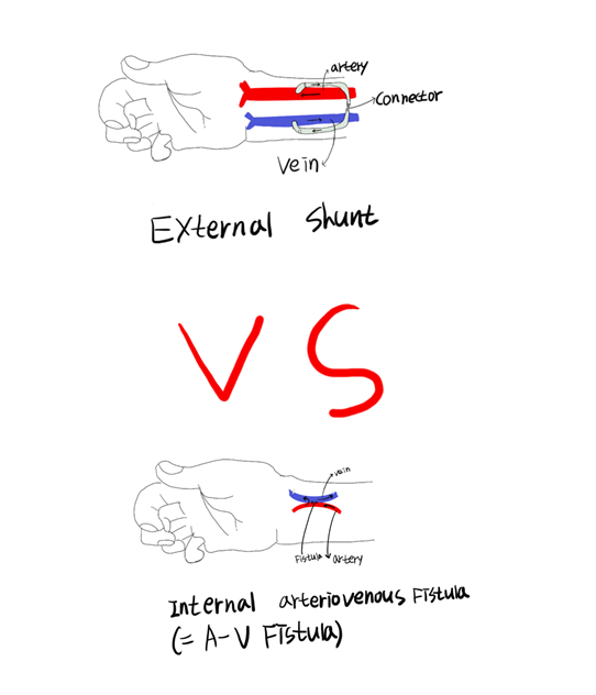 혈액 투석할 때 사용하는 external arteriovenous shunt(외동정맥단락)와 arteriovenous ...
