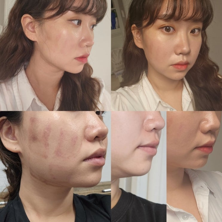 서면써마지 FLX 600샷 통증 효과 총정리 : 네이버 블로그
