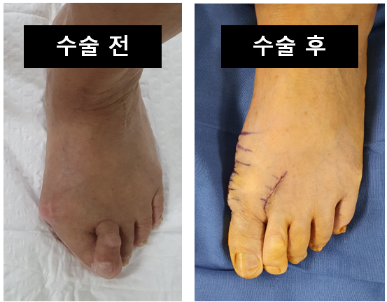 아산 배방 정형외과 프라이드 병원 무지외반증 수술적치료에 대하 알아봅시다 네이버 블로그