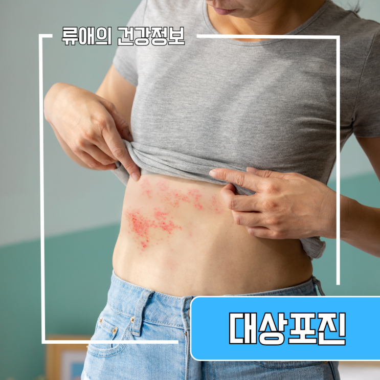 대상포진초기증상 및 원인 치료 대상포진 항바이러스제 정보 네이버 블로그