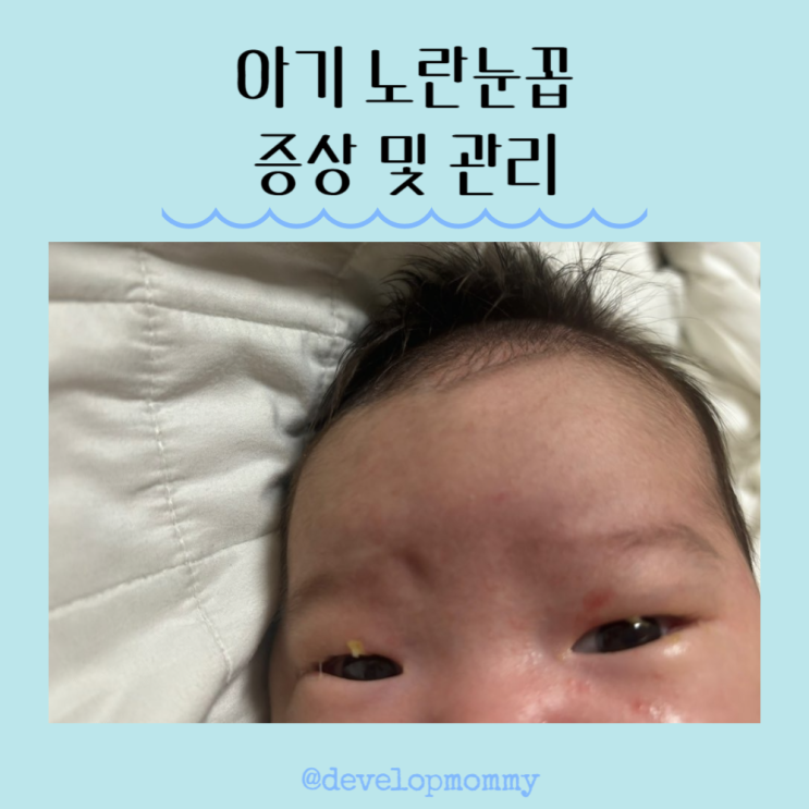 아기노란눈꼽 아기 콧물 눈꼽 감기 증상 및 관리방법 네이버 블로그