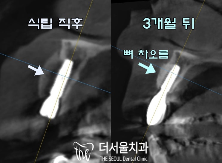 성남치과 에서 브릿지 해야 된다는 앞니 뼈이식 후 임플란트로 자연 치아 처럼 자연스럽게 치료한 증례 네이버 블로그