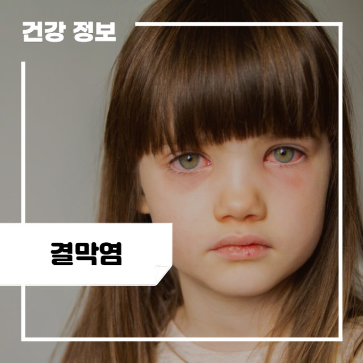 결막염 증상 및 원인 전염 치료 방법 기간 안약 렌즈 알레르기성 세균성 네이버 블로그