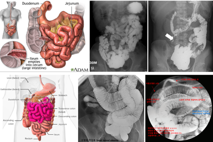 소장조영술(SBS, Small Bowel Series) : 네이버 블로그