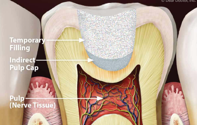 [치의학 #12] 간접치수복조술(Indirect pulp capping) : 네이버 블로그