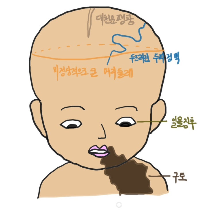수두증 정의 원인 증상 일몰징후 Macewen sign : 네이버 블로그