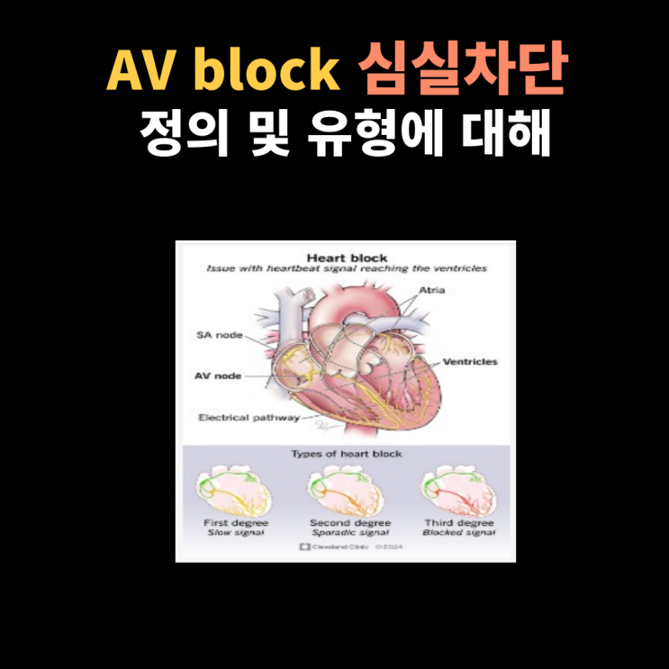AV block 정의 및 유형에 대해서 간호사 관점에서 알아보아요~ : 네이버 블로그
