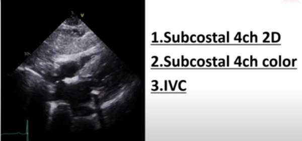 Echo Subcostal 4 chamber view 3개 : 네이버 블로그