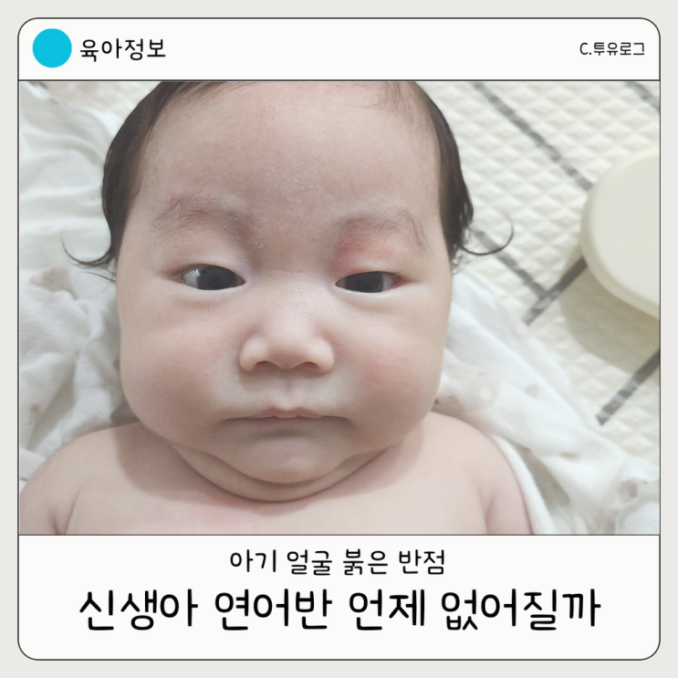 신생아 연어반 눈 이마 주변 아기 붉은 반점 언제쯤 없어질까 네이버 블로그