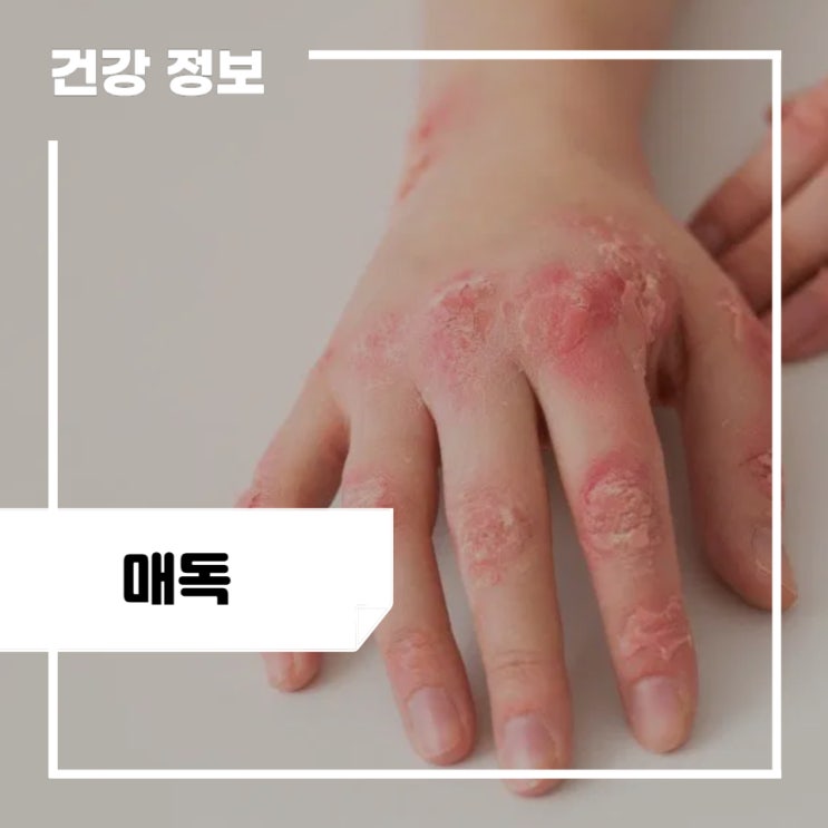 매독 초기 증상 및 원인 검사 양성 치료 후 기간 남자 여자 네이버 블로그
