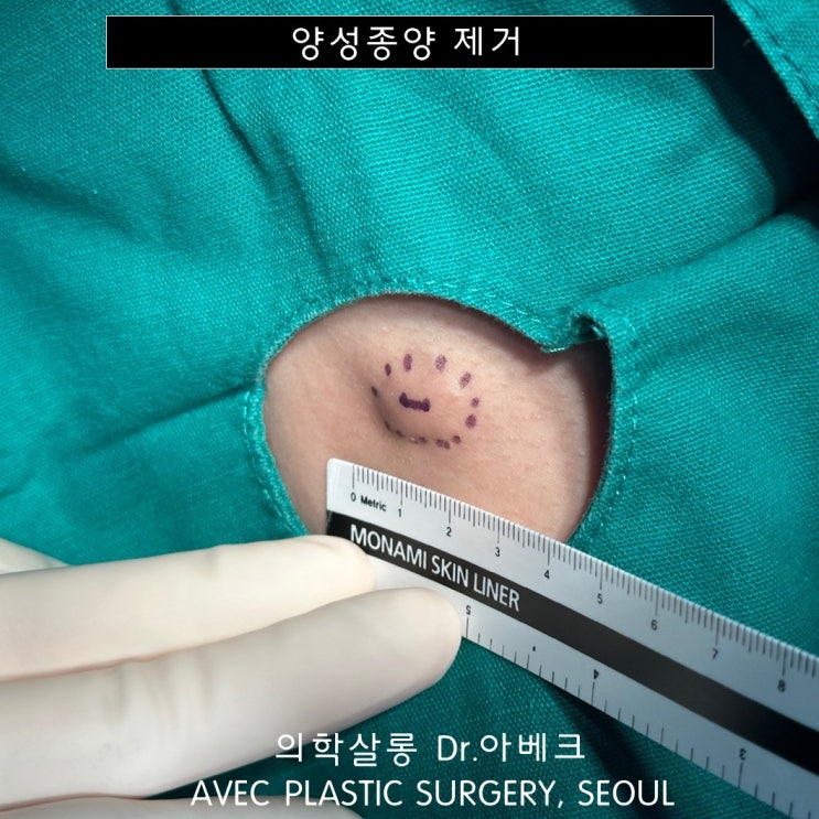 겨드랑이에 생긴 멍울 피지낭 수술 후기 【dr 아베크 양성종양】 네이버 블로그