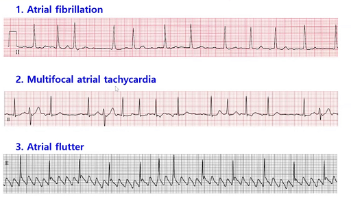 narrow QRS VS wide QRS 비교 : 네이버 블로그