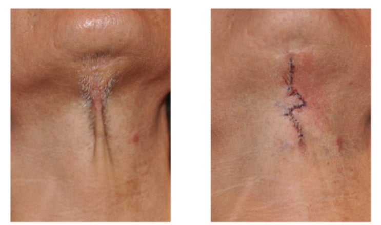 흉터 성형술(scar revision) : 네이버 블로그