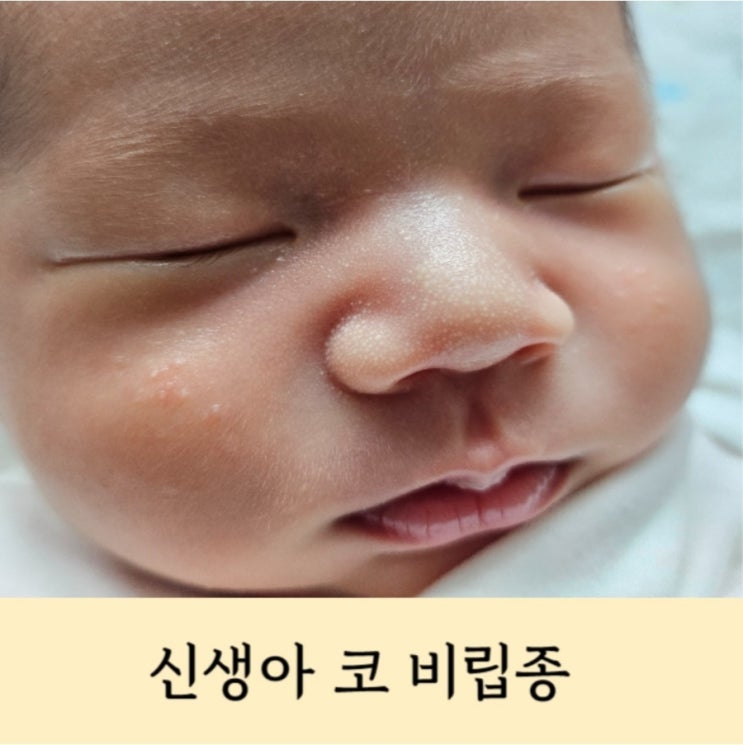 신생아 비립종 아기 코 좁쌀여드름 언제 없어질까 네이버 블로그