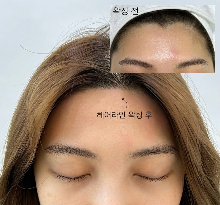 오브무드 광양 중마동 헤어라인 왁싱으로 둥글고 볼륨감 있는 이마로 변신 네이버 블로그