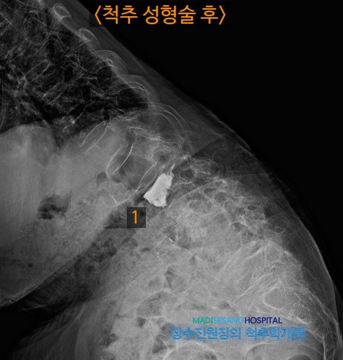 넘어진 기억이 없이 허리가 아픈 제1요추 골다공증성 압박골절 척추 성형술 네이버 블로그