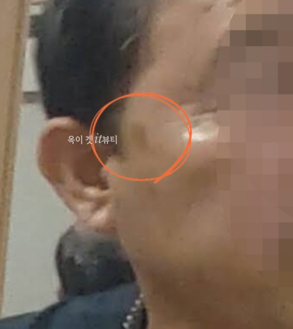 얼굴 손등 검버섯 없애는 법 레이저 비용과 후기 네이버 블로그
