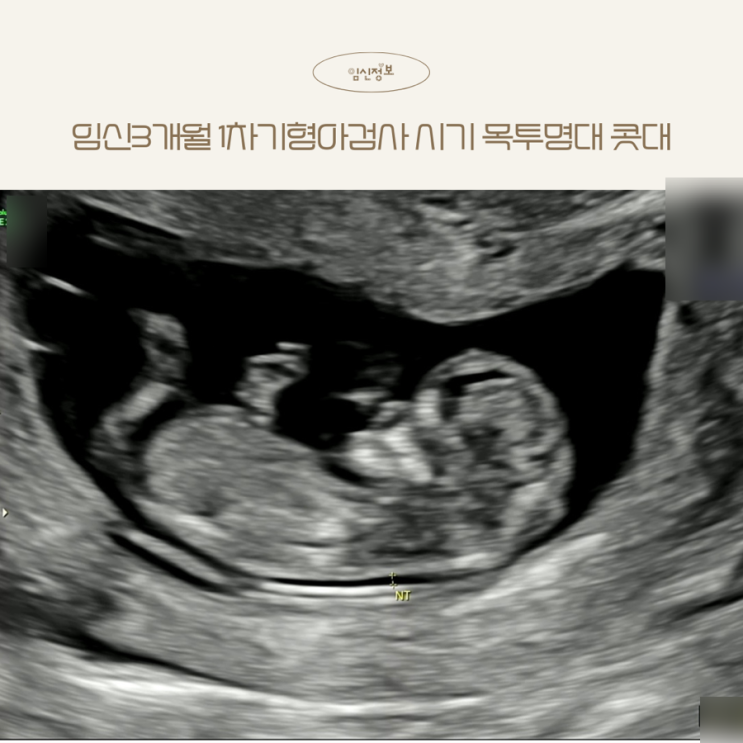 임신3개월 1차기형아검사 시기 목투명대 콧대 초기정밀초음파검사 네이버 블로그