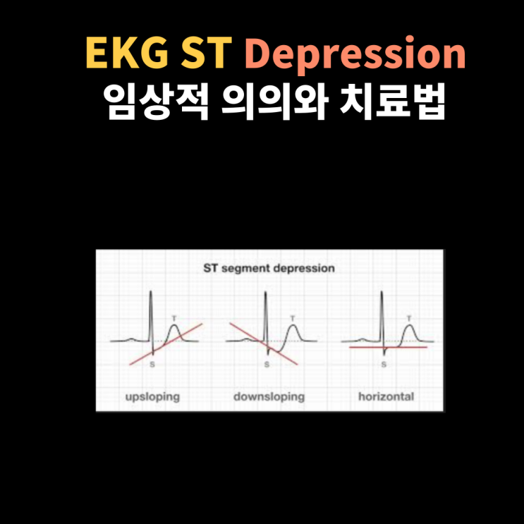 EKG ST depression (ST 하강) : 임상적 의미와 치료에 대해~ : 네이버 블로그