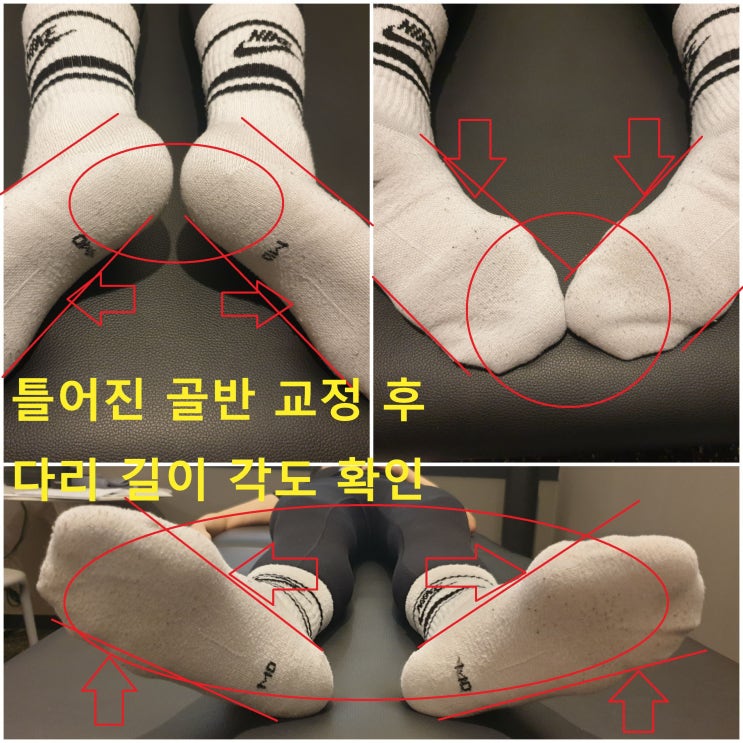 모션업pt 전포점 오늘은 40세 여성 회원분이시고 틀어진 골반 교정 전후 다리 길이 다리 각도 사진입니다 정현호관리자