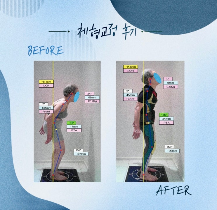 슬리밍고 체형교정 사례 공유 노인 척추 요추 흉추후만증 당일 착용 전 후 비교 30분 후 결과는 네이버 블로그