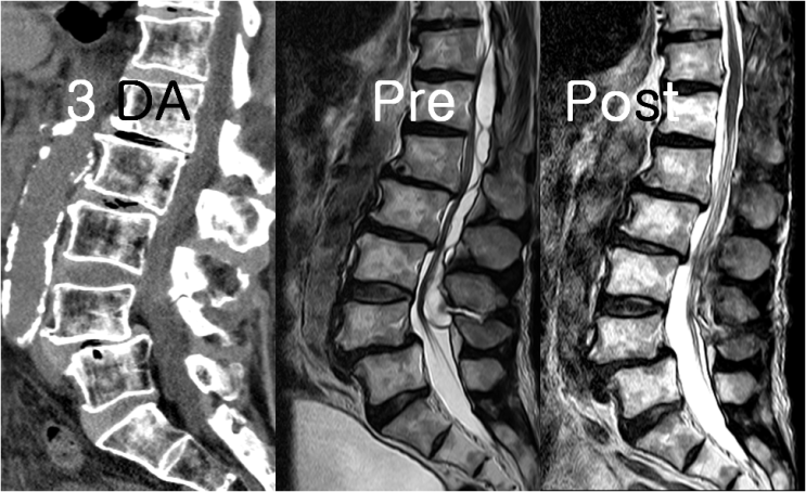 Why MR should be taken 1st! Iso-dense epidural cystic lesion, delayed ...