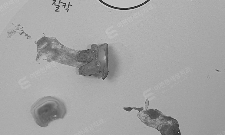 옆으로누운사랑니 양쪽 아래 복잡 매복 발치 사례 10대 남성 네이버 블로그