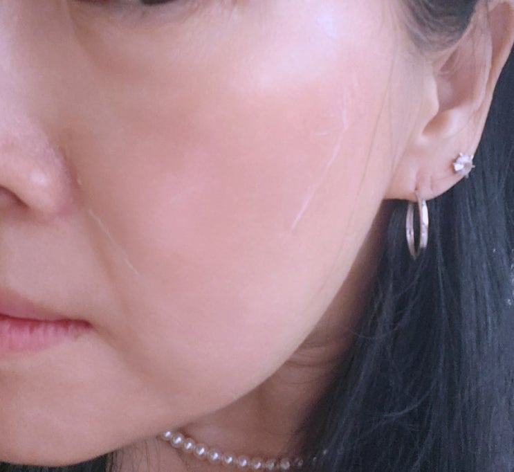 투명썬패치 프란츠 티 안남 홈쇼핑 후기 붙이는 방법 주의 내돈내산 네이버 블로그