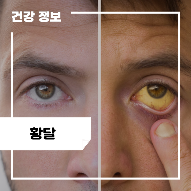 얼굴 눈 황달 증상 및 원인 치료 방법 간수치 신생아 성인 황달 네이버 블로그