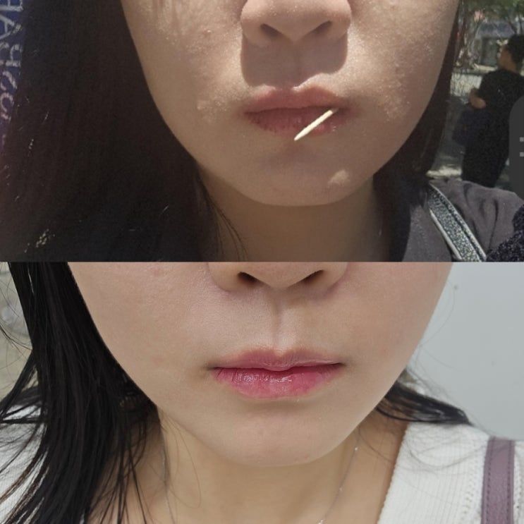 대구중구피부과 팔자필러 추천 벨로테로 볼륨부스터 팔자주름 통증 붓기 전후 후기 정보 : 네이버 블로그