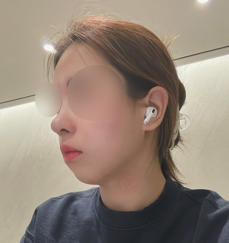 코수술 후기 일주일 ~ 3주 차 붓기 변화 기능코 미용코 수술 후기 코 성형 수술 전후 비교 네이버 블로그