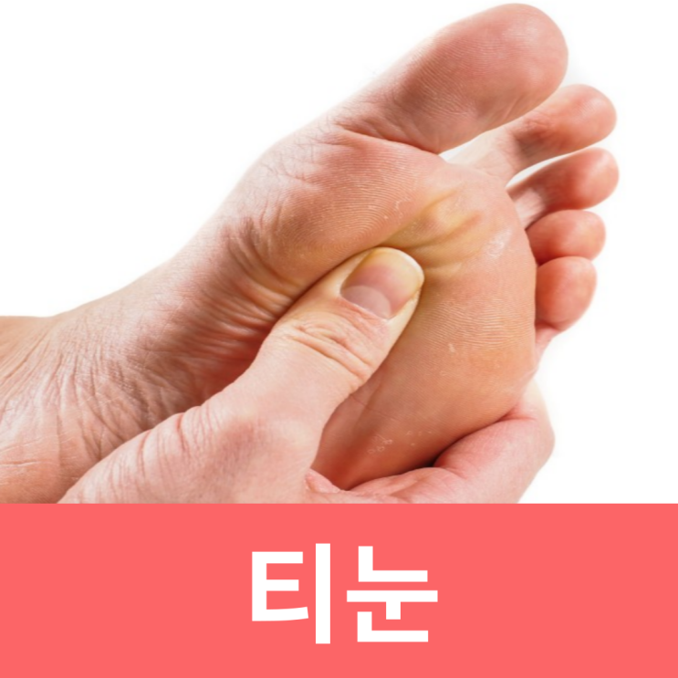 발바닥 발가락 티눈 제거 원인 치료방법 티눈 밴드 약 네이버 블로그