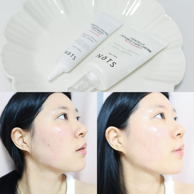 얼굴 뾰루지 점뺀후 관리 홍조 낫츠 센텔라 트러블케어 크림 피부 연고 추천 네이버 블로그