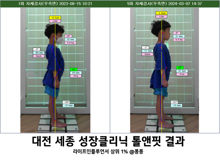 대전 세종 성장클리닉 톨앤핏 아이 6세 7세 키 예상키 숨은키 찾기 체형 분석 교정 관리 네이버 블로그