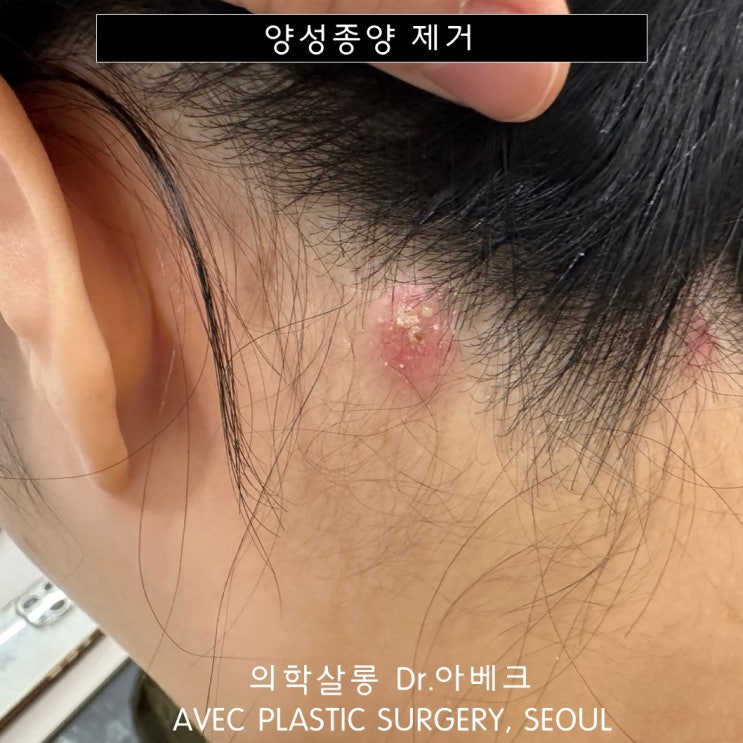 목 피지낭 제거 염증 없을 때 Vs 염증 생겼을 때 【dr 아베크 양성종양】 네이버 블로그