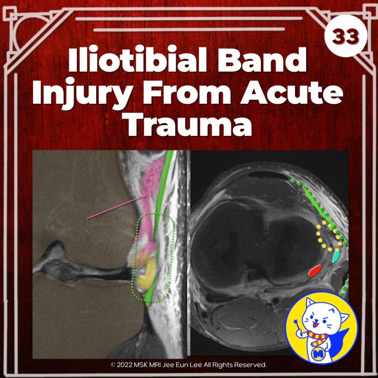 (Fig 3-B.33) Iliotibial Band Injury from Acute Trauma : 네이버 블로그