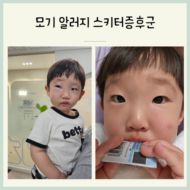 23개월 아기 모기 알러지 스키터증후군 증상 및 병원 진료 후기 네이버 블로그