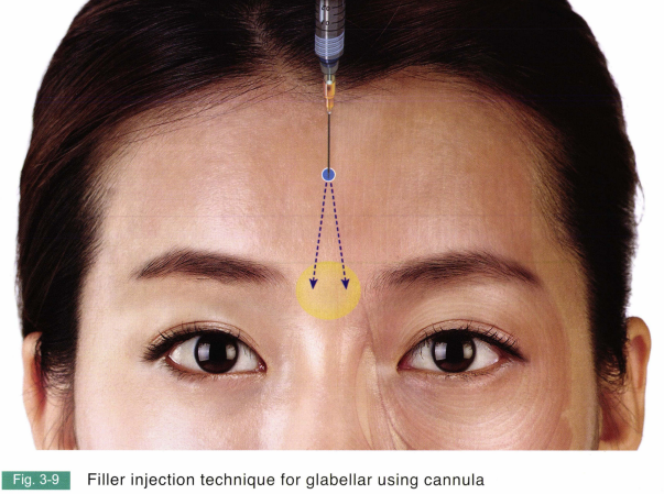 [필러] (4) 미간 필러 (glabella filler) : 네이버 블로그