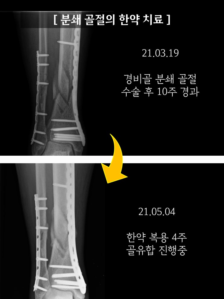 분쇄 골절 수술 후 회복을 위해 추천하는 음식과 간식 네이버 블로그