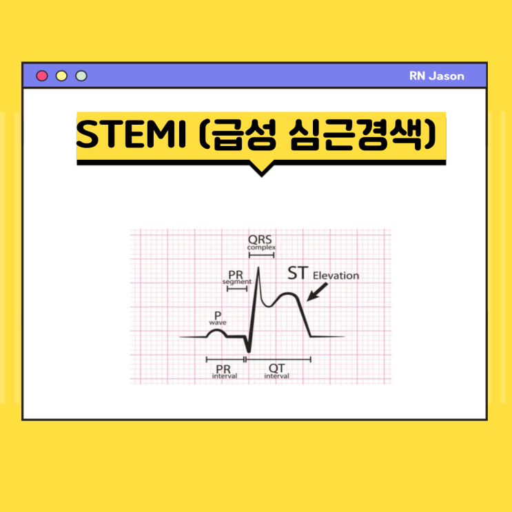 STEMI (급성 심근경색)의 정의, 치료법, EKG, NSTEMI의 차이점에 대해서 알아봐요~ : 네이버 블로그